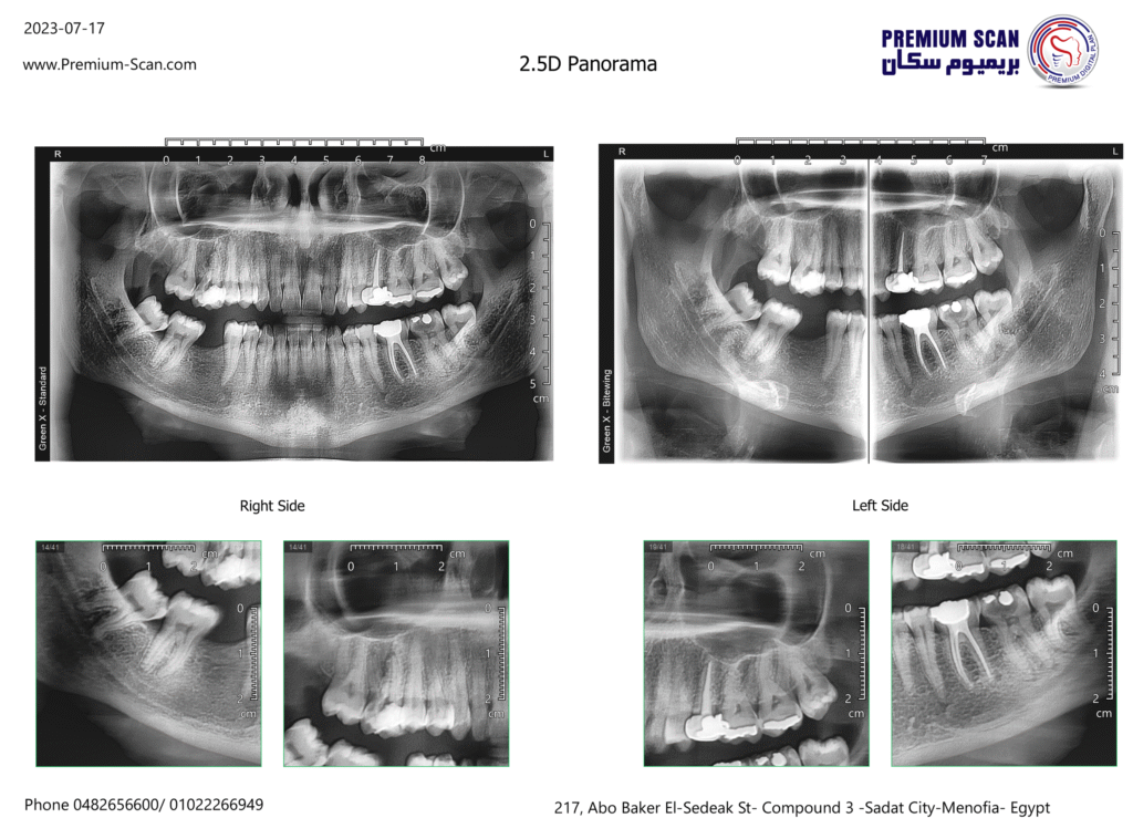 2D BITEWING PANORAMA – Premium-scan